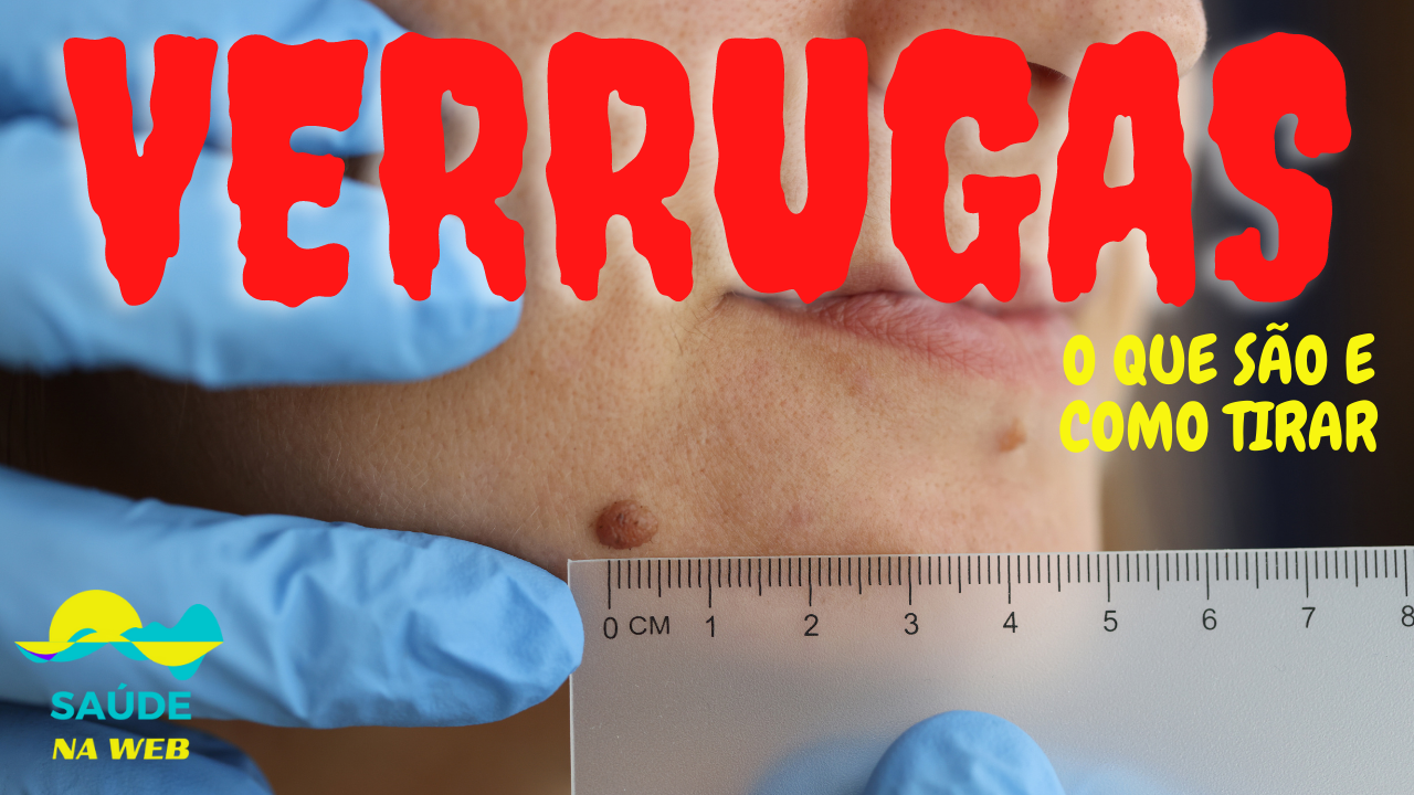 O Que São Verrugas? Quais Os Tipos? Porque Surgem E Como Tirar